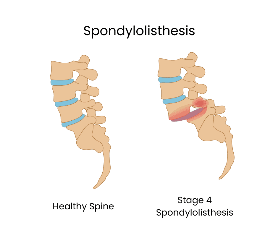 Spondylolisthesis | Orlando Orthopaedic Center